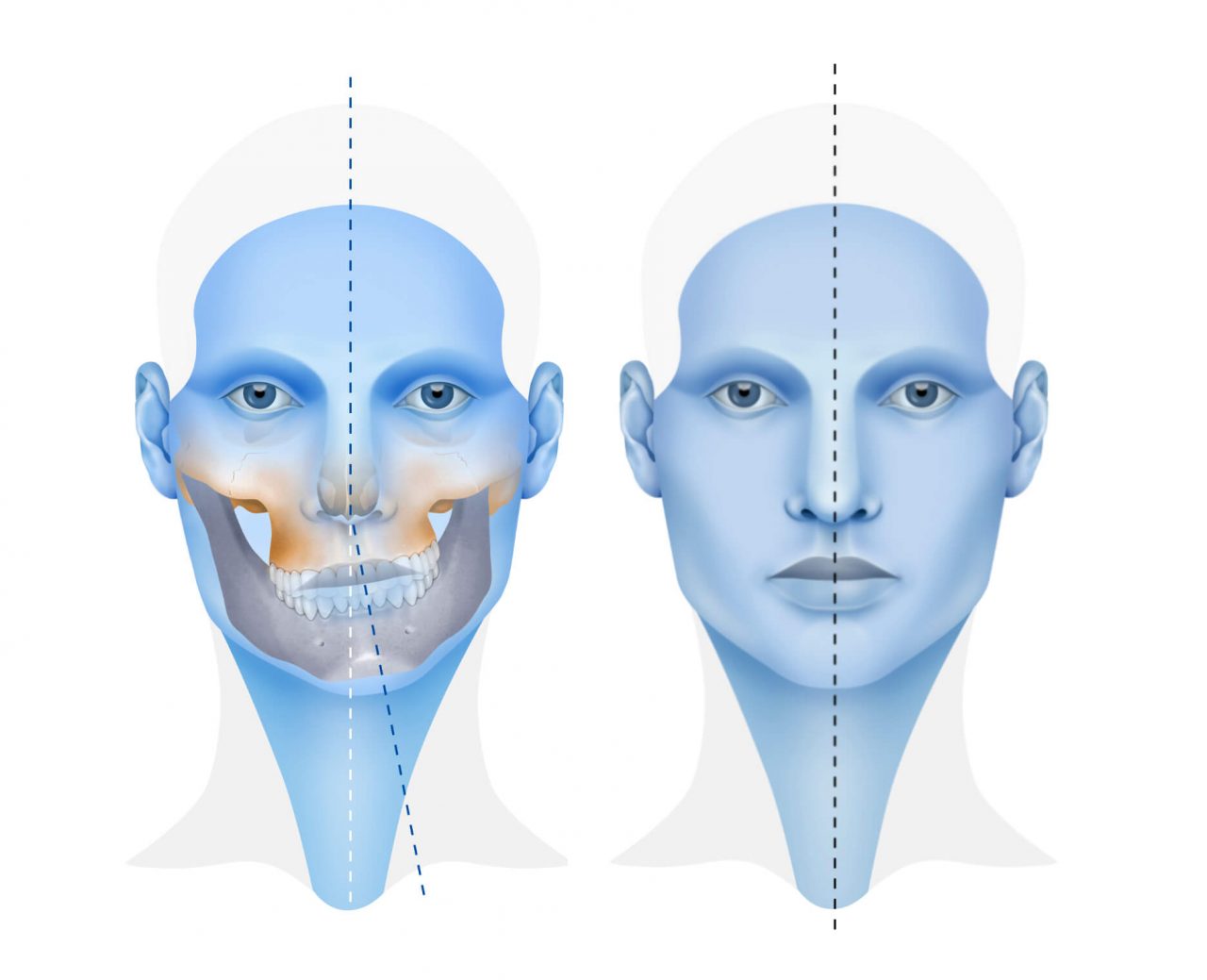 Cirugía del esqueleto facial - Aitziber Yagüe Cortázar